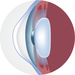 normal_cornea | Keratoconus Institute of Maryland